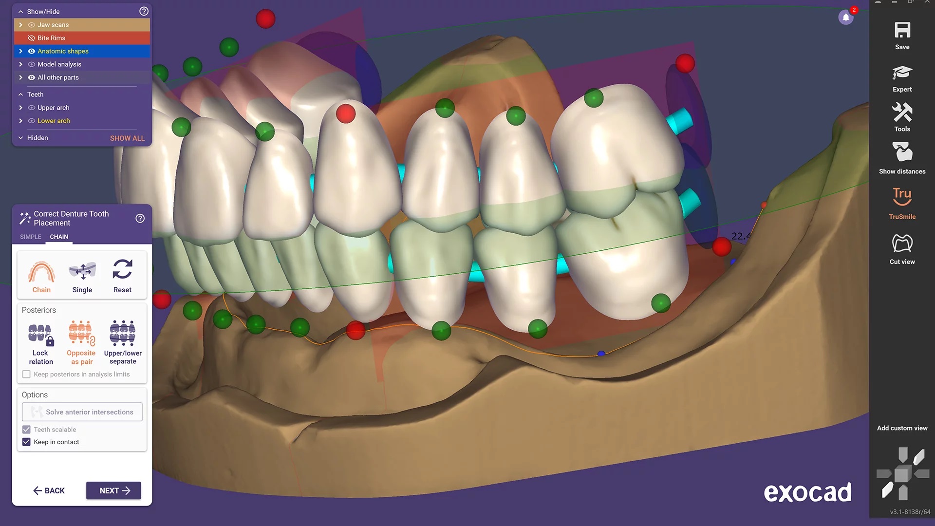 exocad - Powerful CAD solution for dental labs -Authorized Reseller